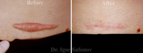 steroid injections hypertrophic scar